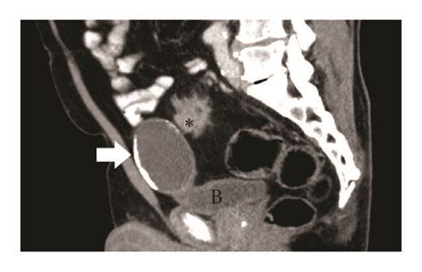 Sagittal Image From Contrast Enhanced Ct Demonstrating A 6 9 Cm Rim