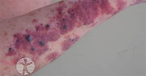 Dermnet® Vascular Malformation Image