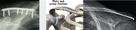 Fractures De Clavicule Dr Yves ROUXEL