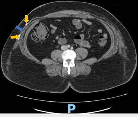 Ct Scan Transverse View Of Abdominal Cavity This Ct Scan Was