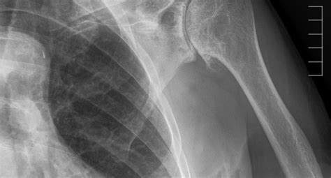 Uw Shoulder And Elbow Academy The B2 Glenoid In A 76 Year Old Active