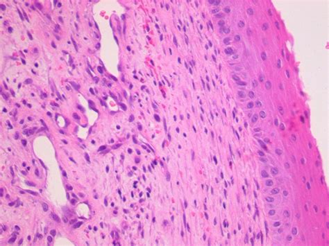 Histologic Section Of The Infratemporal Fossa Tumor Hande Stain Magn Download Scientific