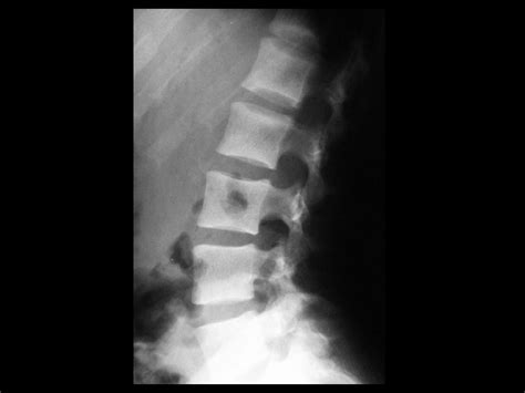 Anterior Shoulder Dislocation Findings Inferomedial Subcoracoid Displacement Of