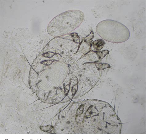 Figure 2 From A Case Of Bullous Scabies Semantic Scholar