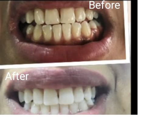 Scaling And Polishing Before And After Smile Studio Dental Clinic