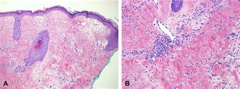 A The Punch Biopsy Contains Diffuse Dermal Sclerosis With Atrophic