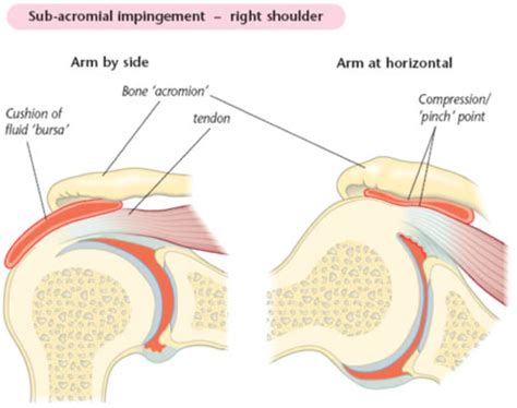 Arthroscopic Sub Acromial Decompression — Campbell Hand — Shoulder