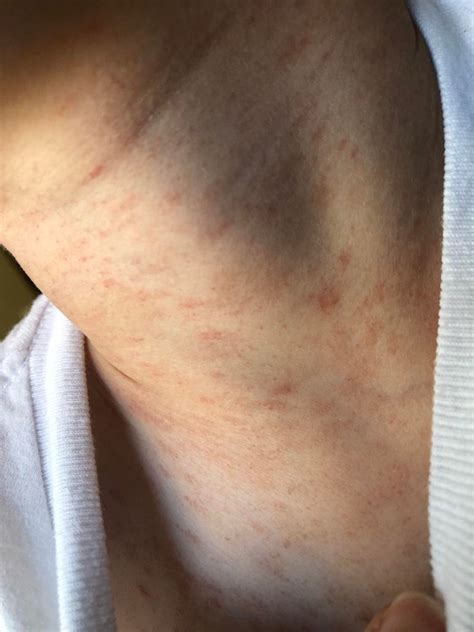 Non Itchy Rash Rdermatologyquestions