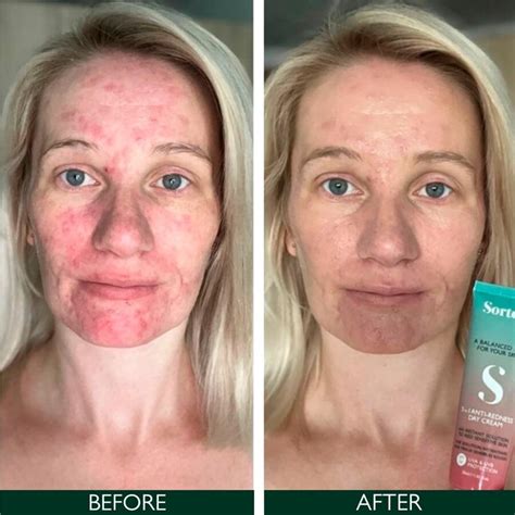 Sorted Skin 5 In 1 Anti Redness Day Cream Spf50 30 Ml Se Tilbud