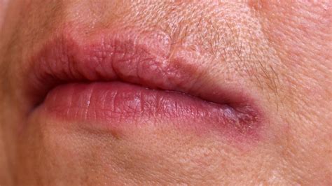 Angular Cheilitis Causes Symptoms Treatment