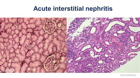 Acute Interstitial Nephritis Txt Renal