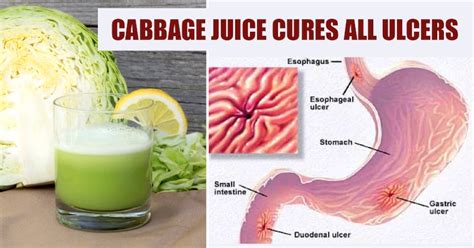 Cabbage Juice For Ulcers