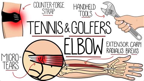 Understanding Tennis Elbow And Golfers Elbow Lateral And Medial