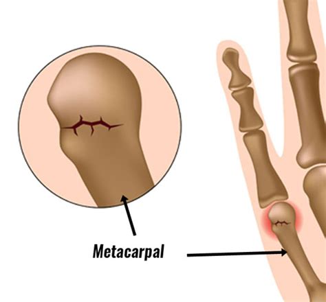 Boxers Fracture Symptoms Causes Treatment And Surgery