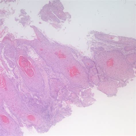 Incisional Biopsy Of The Skin Lesion Showing A Well‐differentiated