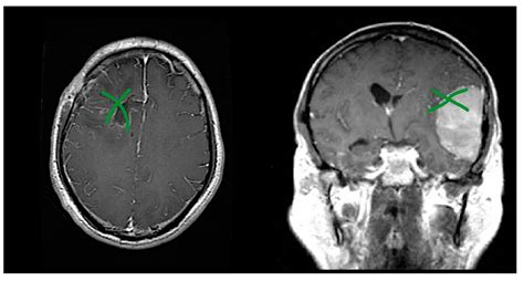 Applied Sciences Free Full Text Brain Tumor Detection With Deep Learning Methods Classifier