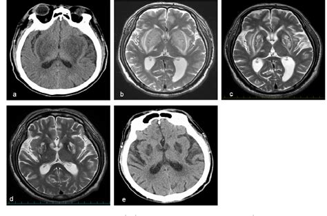 Figure 1 From Case Report A Case Of Encephalopathy Presenting The