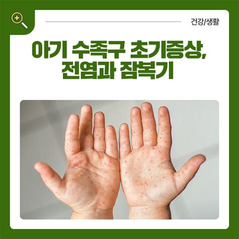 아기 수족구 초기증상 전염과 잠복기 네이버 블로그