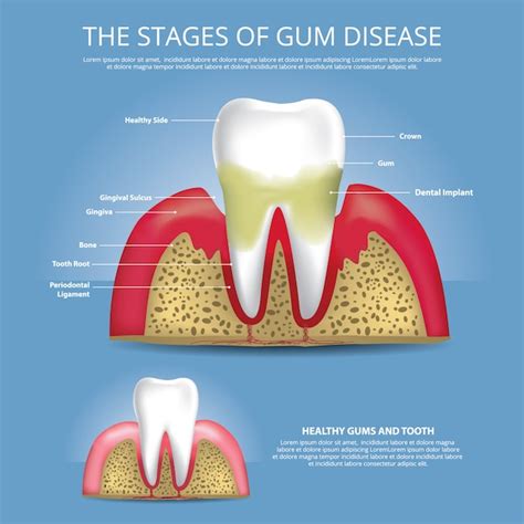Premium Vector Human Teeth Stages Of Gum Disease Illustration