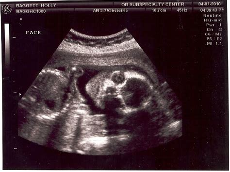 Baggett Basics Ultrasound 20 Weeks