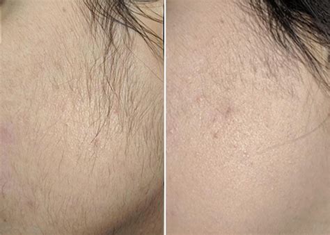 Laser Hair Removal Toronto 3d Lifestyle