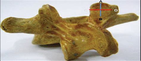 Quantitative Morphometric Analysis Of The Lumbar Vertebral F Journal Of Craniovertebral