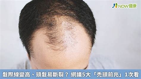 髮際線變高、頭髮易斷裂？ 網議5大「禿頭前兆」1次看 Now健康 Line Today