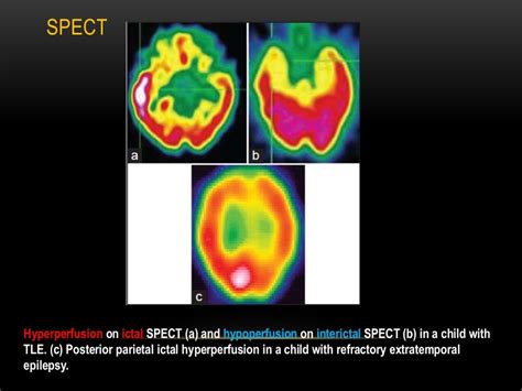 Mesial Temporal Lobe Epilepsy