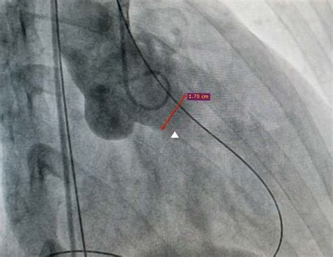 Aortic Root Angiogram Showing Aneurysmal Sac Arrowhead Of Right Download Scientific Diagram
