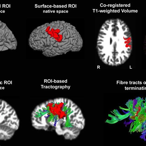 Automated Tract Dissections Using Surface Based Clusters A The
