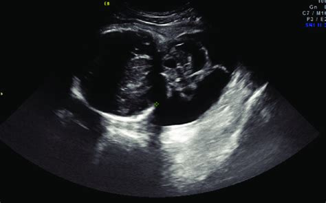 Encephalocele Ultrasound