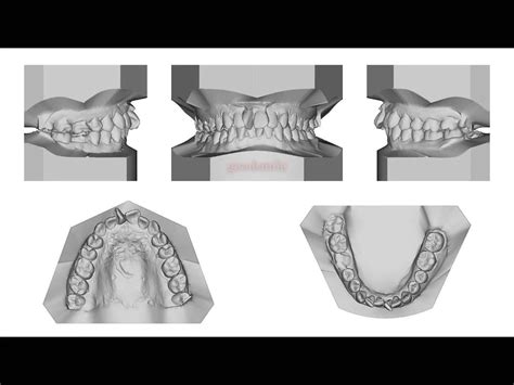 Camouflage Treatment Of Skeletal Class Ii Dental 굿스마일포럼