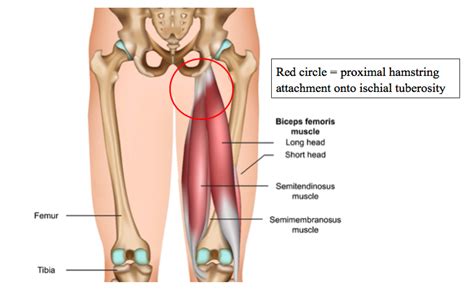 Proximal Hamstring Tendinopathy Logan Physiotherapy