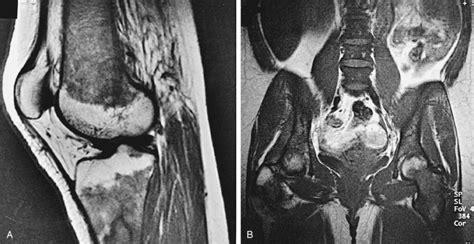 Marrow Radiology Key