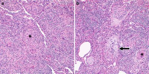 Granulomatous Lymphocytic Interstitial Lung Disease Ild Download Scientific Diagram