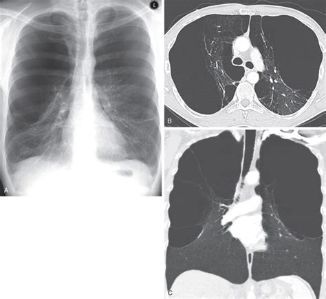 Copd Ct Scan Findings