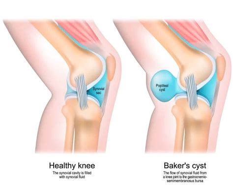 Bakers Cyst Symptoms Causes And Diagnosis Behind The Knee