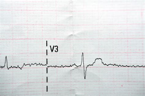 Blog Premature Atrial Contractions Management Cardiologymaster