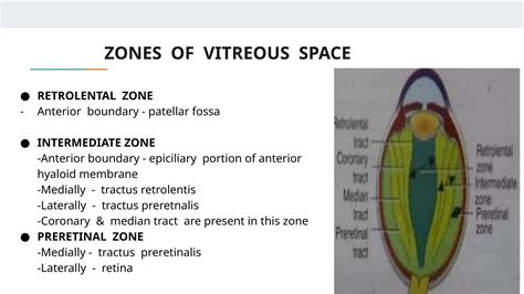 Vitreous Loss Secondary To Cataract Surgery Ppt