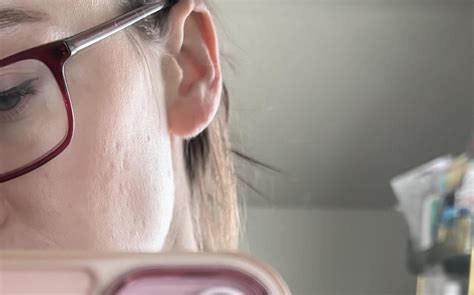 Would You Say These Are Acne Scars Or Pie Both Racnescars