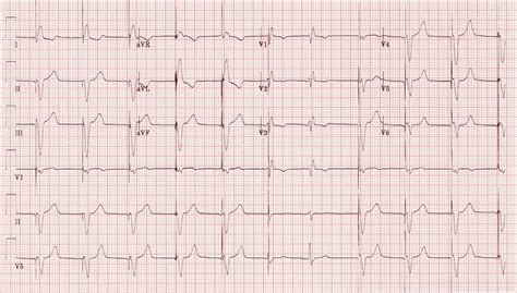 Pacemaker Ritimleri Normal Pacemaker İşlevi Acilcinet