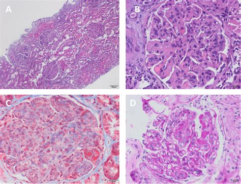 Inmunoglobulin Mediated Glomerulonephritis And Mixed Cryoglobulinemia