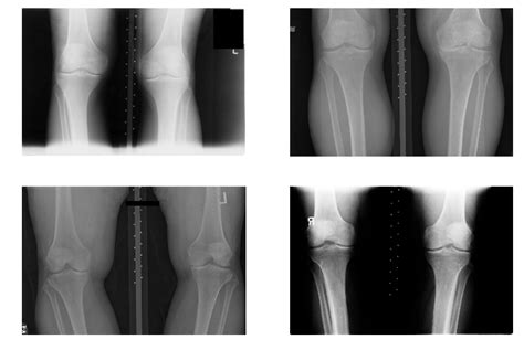 Feature Learning To Automatically Assess Radiographic Knee