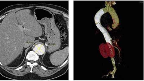 71 Year Old Patient With A Thoraco Abdominal Aortic Aneurysm Crawford