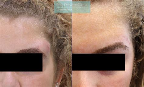 Mole Cyst And Skin Tag Removal Cost Mole Cyst Wart Skin Tag Removal Price