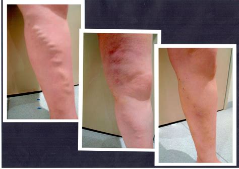 Endovenous Laser Ablation Endovascular Wa