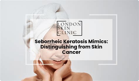 Seborrheic Keratosis Removal Healing Time London Skin Clinic