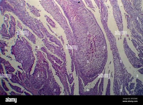 Bladder Transitional Cell Carcinoma Light Micrograph Photo Under