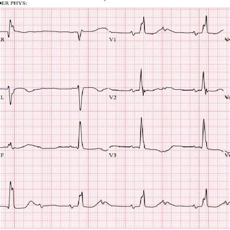 Chest X Ray Finding After Placement Of Biventricular Pacemaker