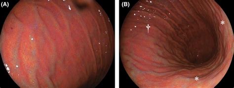 Diffuse Redness In Linked Color Imaging Is Useful For Diagnosing Current Helicobacter Pylori